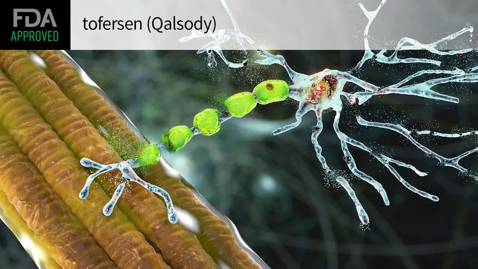 Il Qalsody (tofersen) approvato da FDA - Radio Roma Capitale